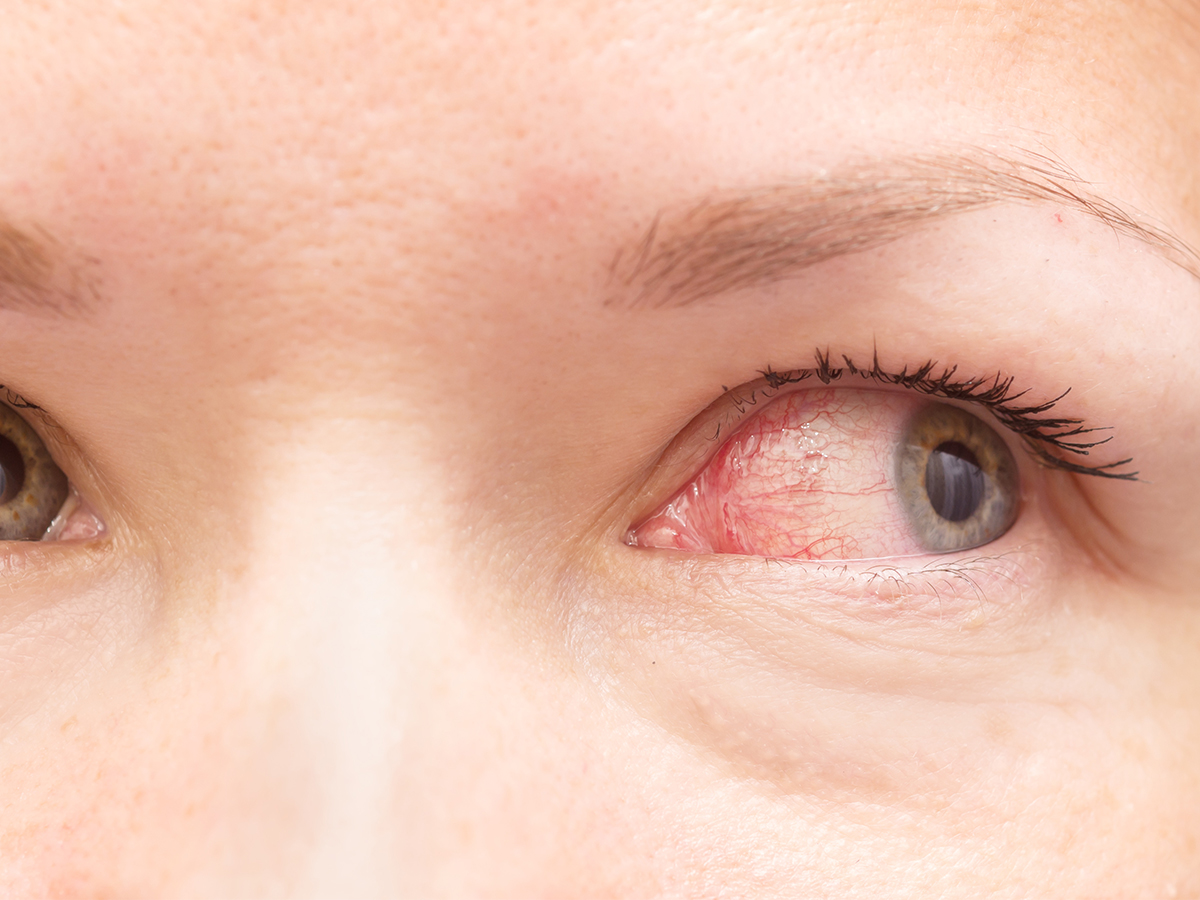 Pink Eye All You Need To Know In 6 Photos