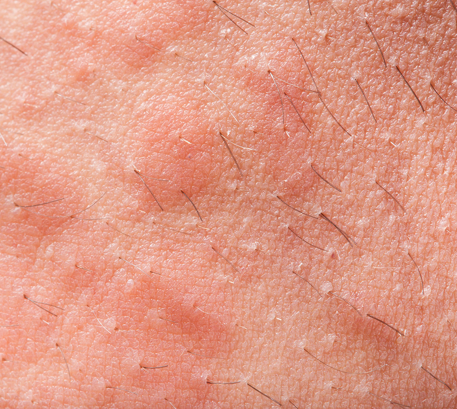 Common Rashes: Causes, Symptoms, and Treatment