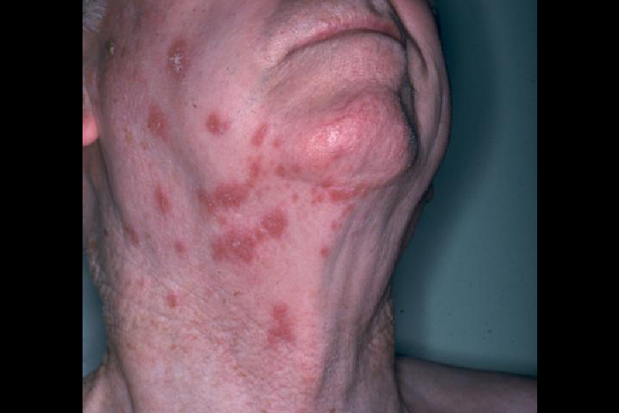 Chickenpox and Shingles: All You Need to Know in 10 Photos